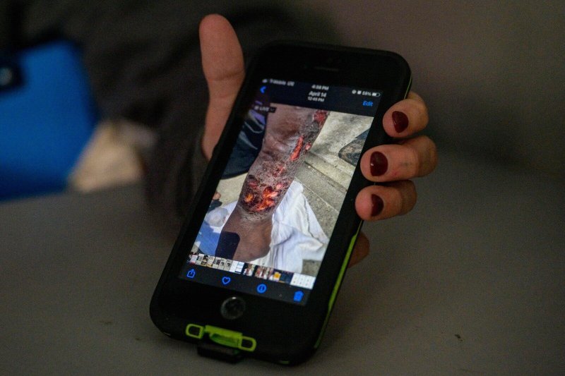 „Zombie”-Droge Xylazin frisst Abhängige in den USA förmlich auf ...